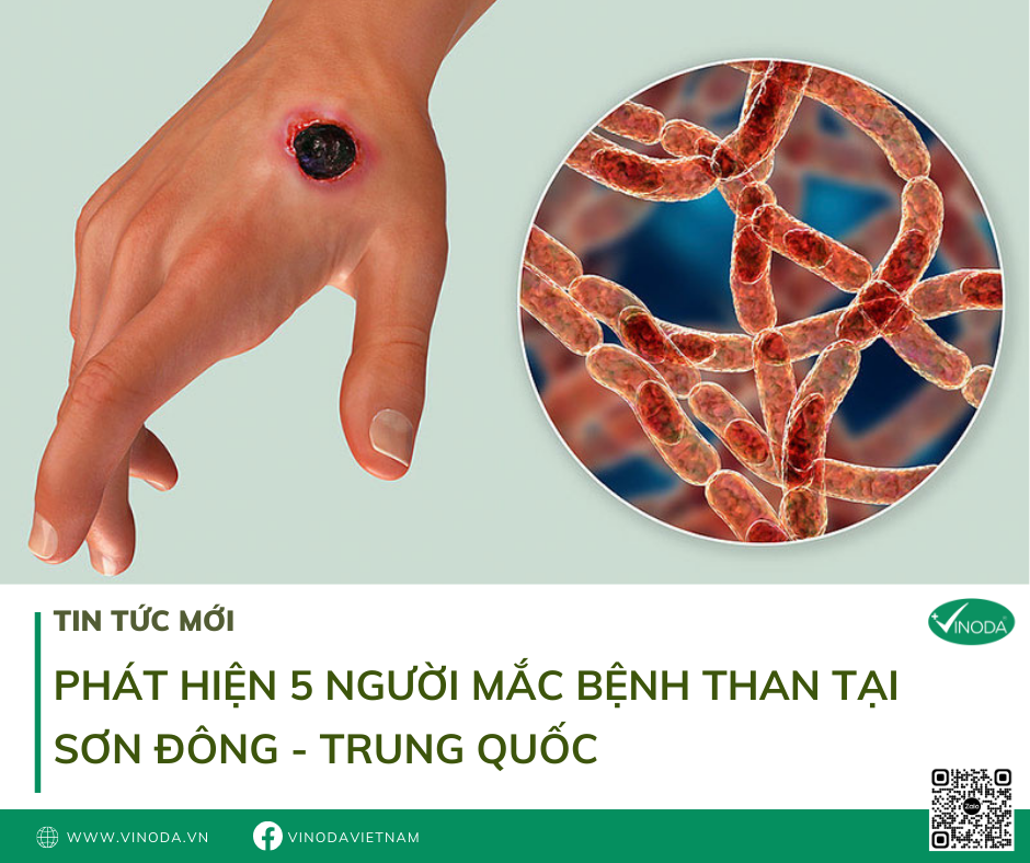 PHÁT HIỆN 5 NGƯỜI MẮC BỆNH THAN TẠI SƠN ĐÔNG - TRUNG QUỐC – Công ty TNHH Thương Mại VINODA