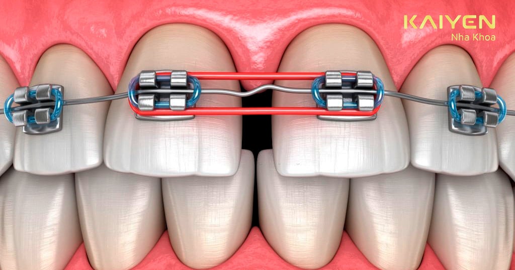 Đóng khoảng trong niềng răng như thế nào? Mất bao lâu? – Nha khoa Quốc Tế KAIYEN