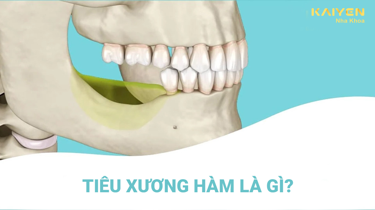 Tiêu xương hàm là gì? Nguyên nhân, dấu hiệu và cách khắc phục hiệu quả – Nha khoa Quốc Tế KAIYEN