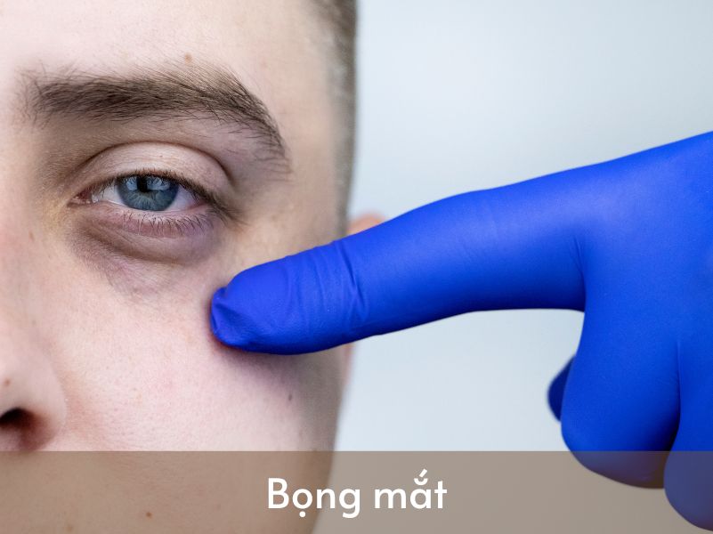 Mẹo khắc phục tình trạng bọng mắt an toàn, hiệu quả