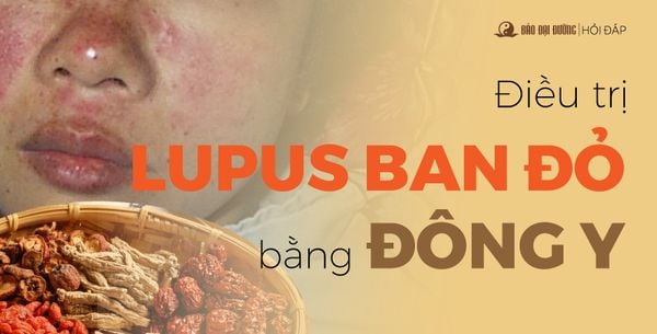 Điều trị bệnh Lupus ban đỏ theo Đông y – BẢO ĐẠI ĐƯỜNG