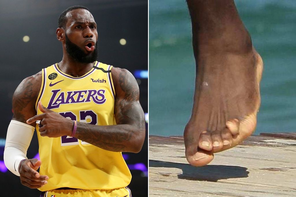 Ngón chân biến dạng của các VĐV bóng rổ sau khi thi đấu – AUTHENTIC SHOES