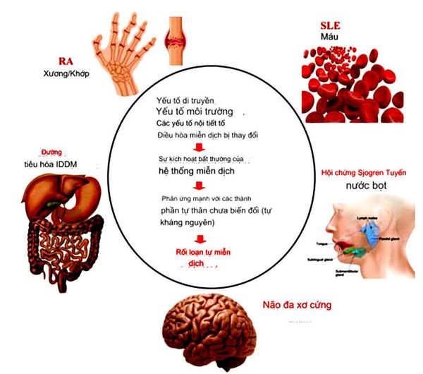 Phản ứng tự miễn dịch và viêm trong bệnh Lupus ban đỏ | Hydro cho sức khỏe