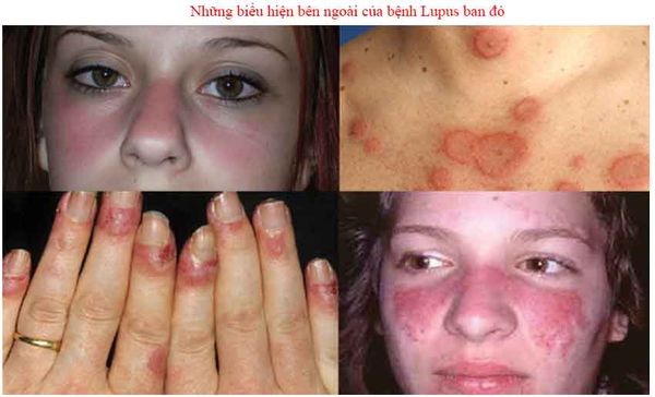 Liệu pháp dùng hydro cải thiện bệnh Lupus ban đỏ | Hydro cho sức khỏe