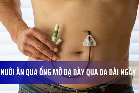 Nuôi ăn qua ống mở dạ dày qua da dài ngày tại nhà – Merinco