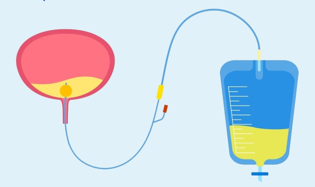 Những câu hỏi thường gặp khi sử dụng ống thông tiểu Foley – Merinco