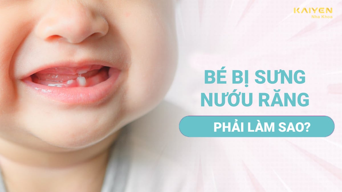 Bé bị sưng nướu răng phải làm sao? Cách điều trị như thế nào? – Nha ...
