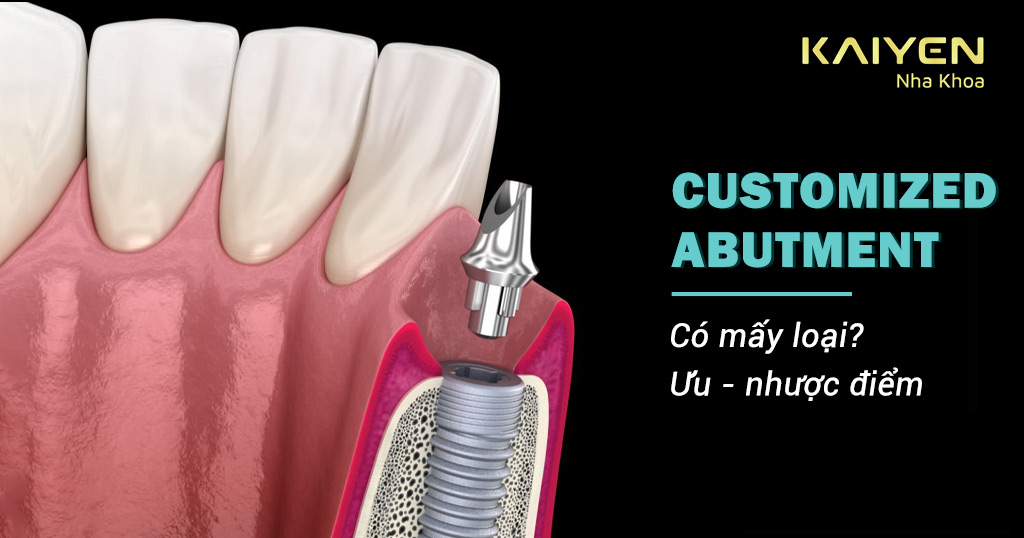 Customized Abutment trong cấy Implant là gì? Khi nào sử dụng? – Nha ...