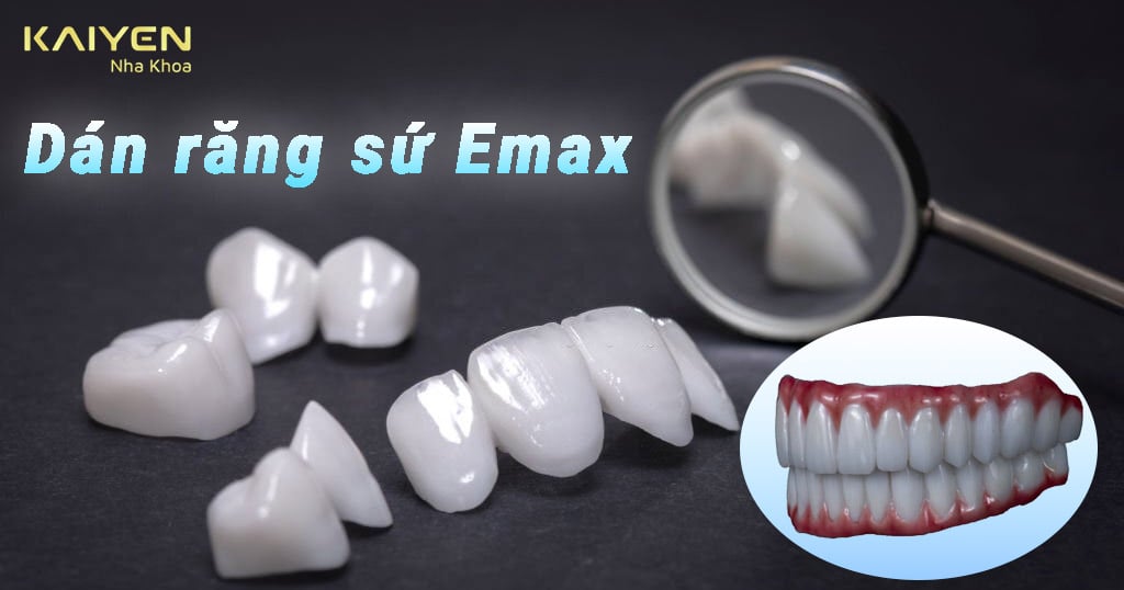 Dán răng sứ Emax có tốt không? Cập nhật giá dán sứ Veneer Emax – Nha ...