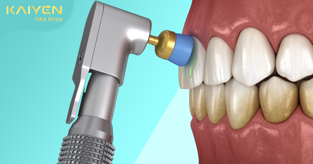 Đánh bóng răng là gì? Có nên không? Giá bao nhiêu? – Nha khoa Quốc Tế ...