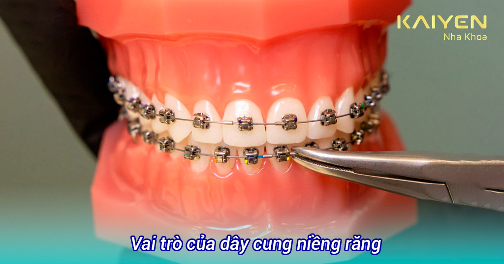 Tìm hiểu về dây cung niềng răng và những lợi ích của nó