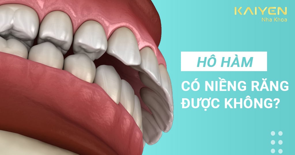 Hô hàm có niềng răng được không? Giải pháp nào tốt? – Nha khoa Quốc Tế ...