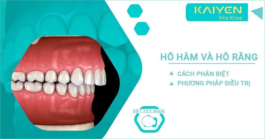 Hô hàm và hô răng: Cách phân biệt và phương pháp điều trị – Nha khoa ...