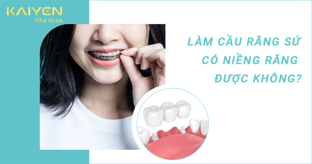 [Giải đáp] Làm cầu răng sứ có niềng răng được không? – Nha khoa Quốc Tế ...