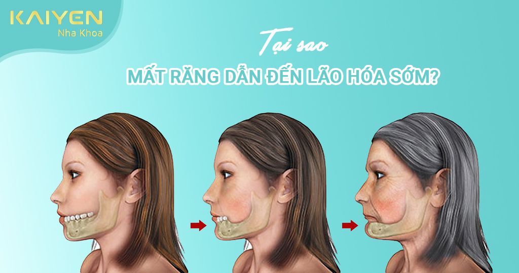 Mất răng làm trồi răng đối diện: Hậu quả và cách khắc phục – Nha khoa ...