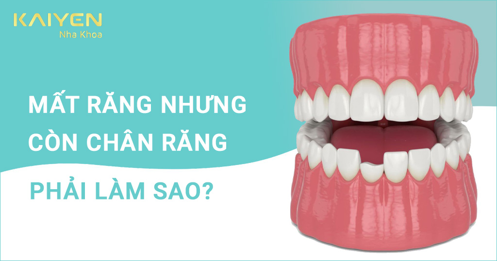 Mất răng nhưng còn chân răng phải làm sao? Cách phục hình tốt? – Nha ...