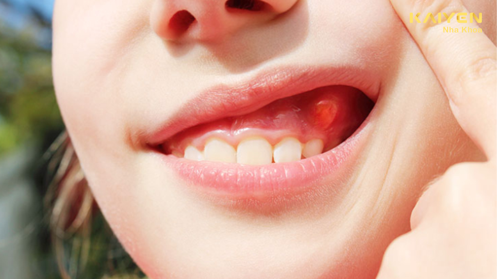 Nang thân răng là gì? Có nguy hiểm không? Cách điều trị như thế nào ...