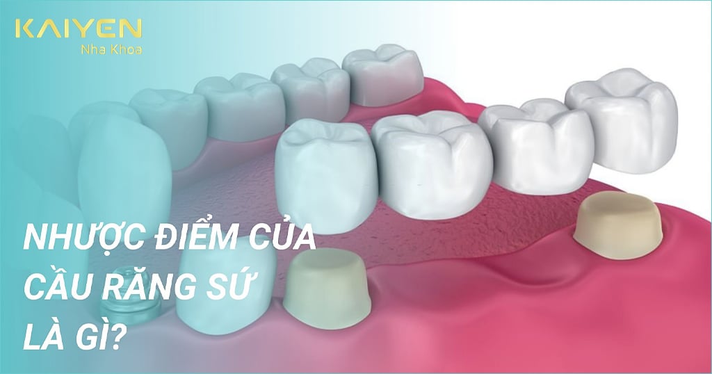 Nhược điểm của cầu răng sứ là gì? Có nên làm không? – Nha khoa Quốc Tế ...