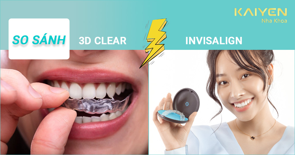 So sán niềng răng 3D Clear và Invisalign (ưu nhược điểm, giá thành ...
