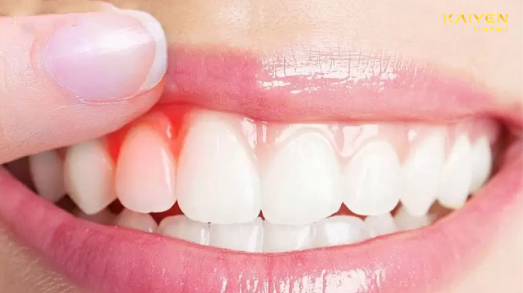 Sưng nướu răng bao lâu thì khỏi? Cách điều trị và phòng ngừa hiệu quả ...