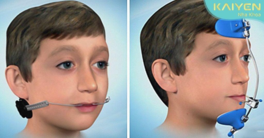 Những điều quan trọng cần biết về Headgear chỉnh nha – Nha khoa Quốc Tế KAIYEN