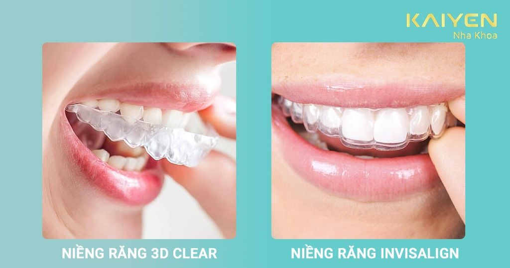 So sán niềng răng 3D Clear và Invisalign (ưu nhược điểm, giá thành ...