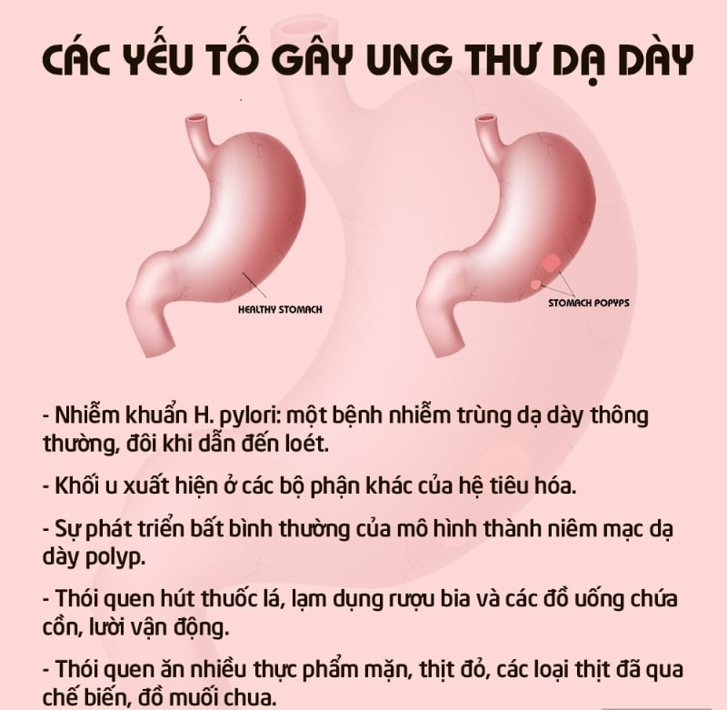 Ung thư dạ dày là gì? Biểu hiện của ung thư dạ dày – Dinh dưỡng y học