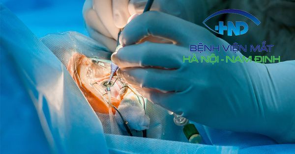 Mổ Phaco Đục Thủy Tinh Thể Có Đau Không? Giải Đáp Chi Tiết Từ Chuyên G