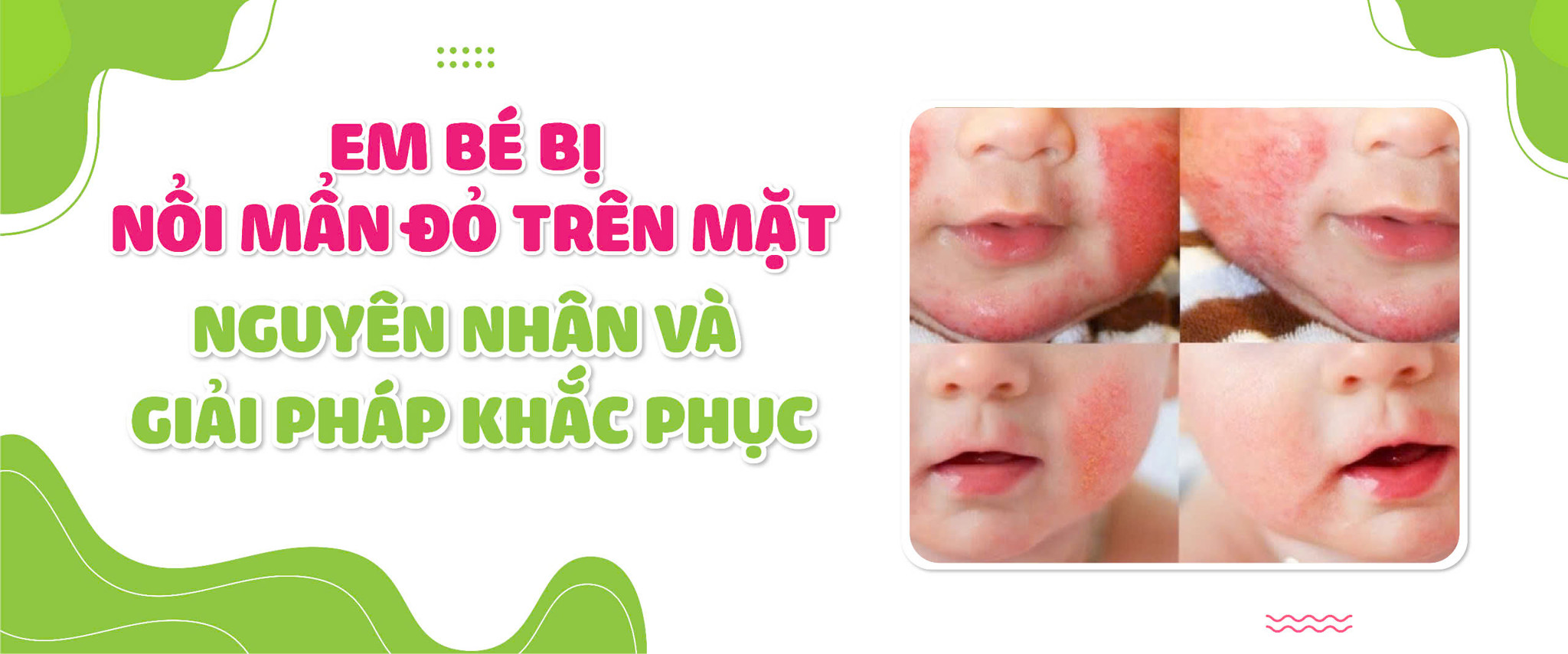 Em bé bị nổi mẩn đỏ trên mặt: Nguyên nhân và giải pháp khắc phục