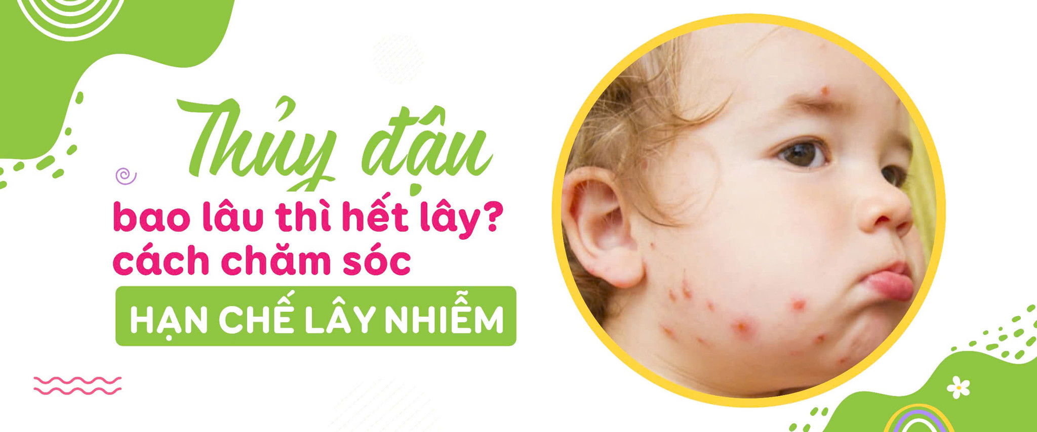 Thuỷ đậu bao lâu thì hết lây?