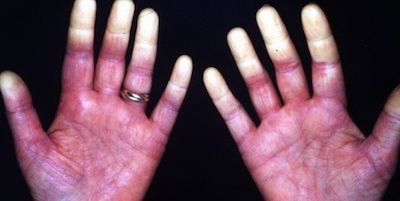 Hội chứng Raynaud – dalieuonline