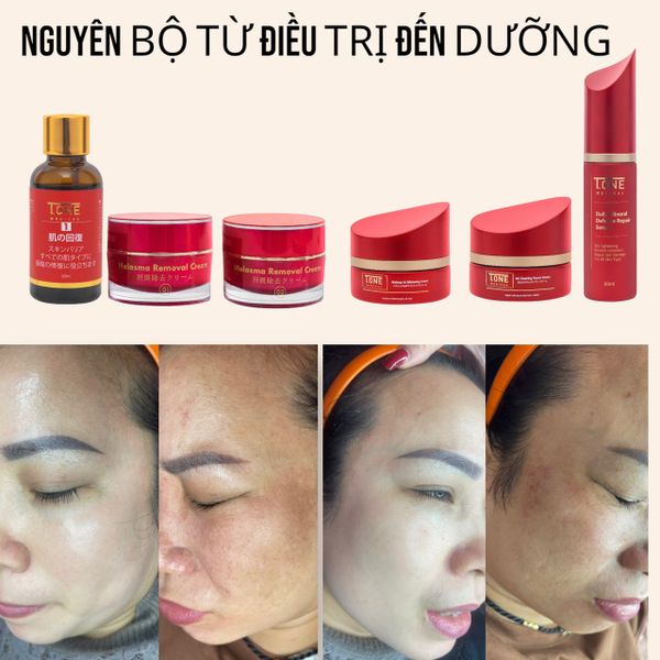 Công nghệ trị nám độc quyền từ Nhật Bản PIO PLUS