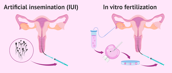What’s the Difference Between IVF and IUI? ivfholymothers