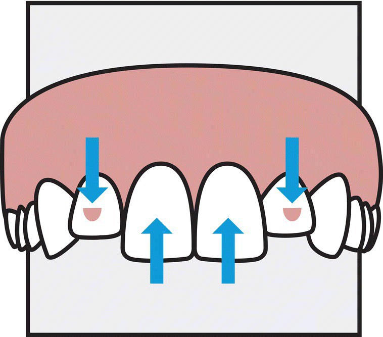 Thiết kế và tối ưu attachment trong chỉnh nha trong suốt với Smilers ...