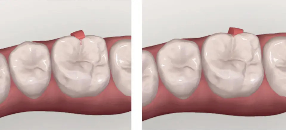 Thiết kế và tối ưu attachment trong chỉnh nha trong suốt với Smilers ...