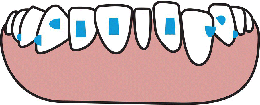 Thiết kế và tối ưu attachment trong chỉnh nha trong suốt với Smilers ...
