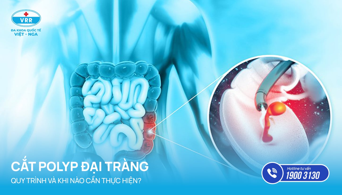 CẮT POLYP ĐẠI TRÀNG: QUY TRÌNH VÀ KHI NÀO CẦN THỰC HIỆN? – Đa Khoa Quốc ...