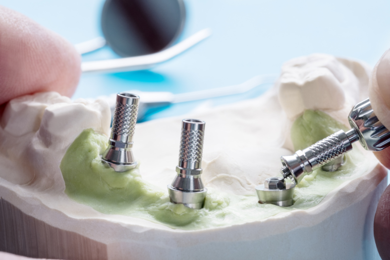 Tìm Mua Implant Chất Lượng Tại Cao Bằng – Unident - Uni Dental Solutions