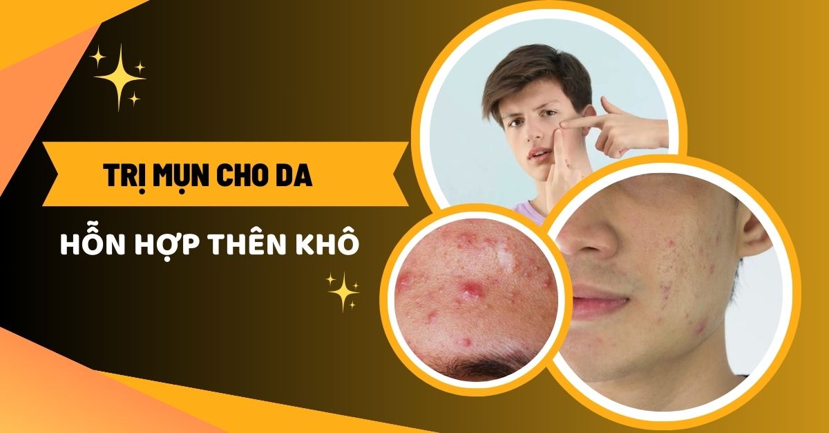 #5 Kem Trị Mụn Cho Da Hỗn Hợp Thiên Khô "Hiệu Quả Tận Gốc" – Fanmen
