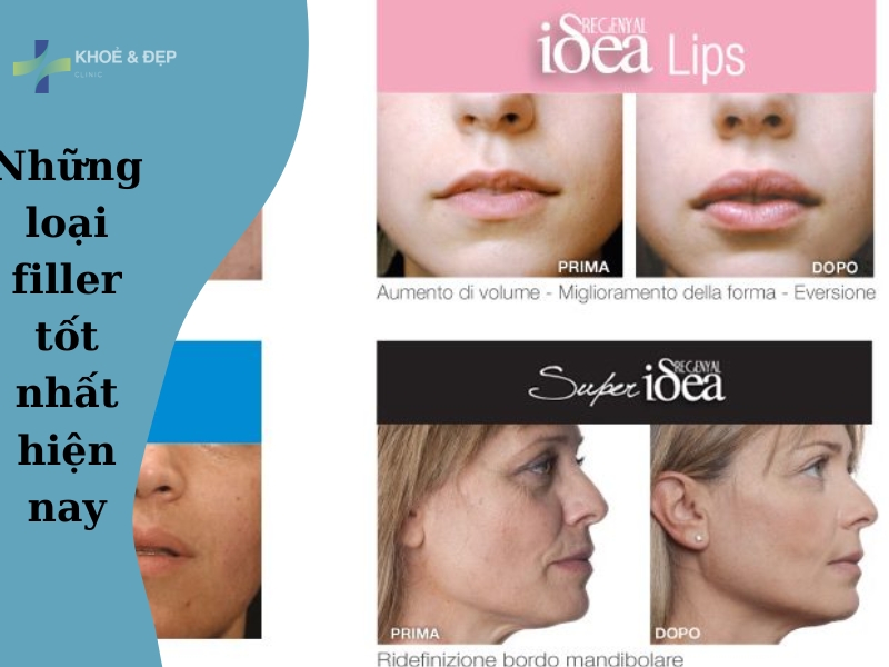 Tiêm filler là gì? Ưu nhược điểm của phương pháp tiêm filler – KHOẺ ...