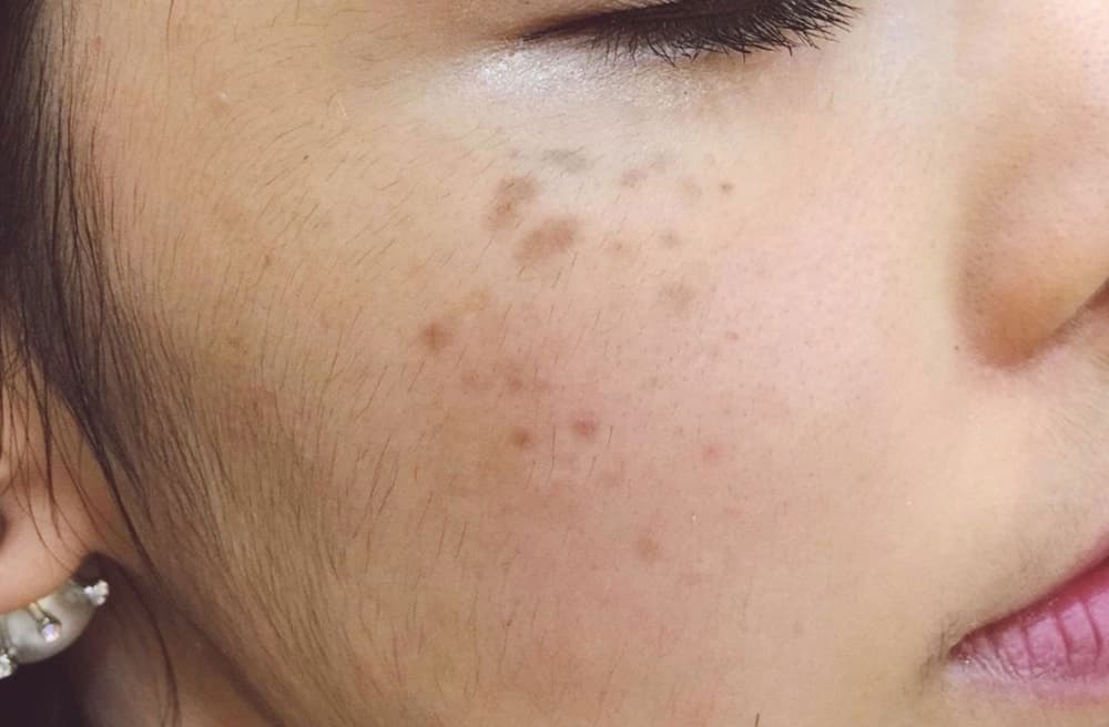 Nevus Hori – Dr Lê Hoài Hương