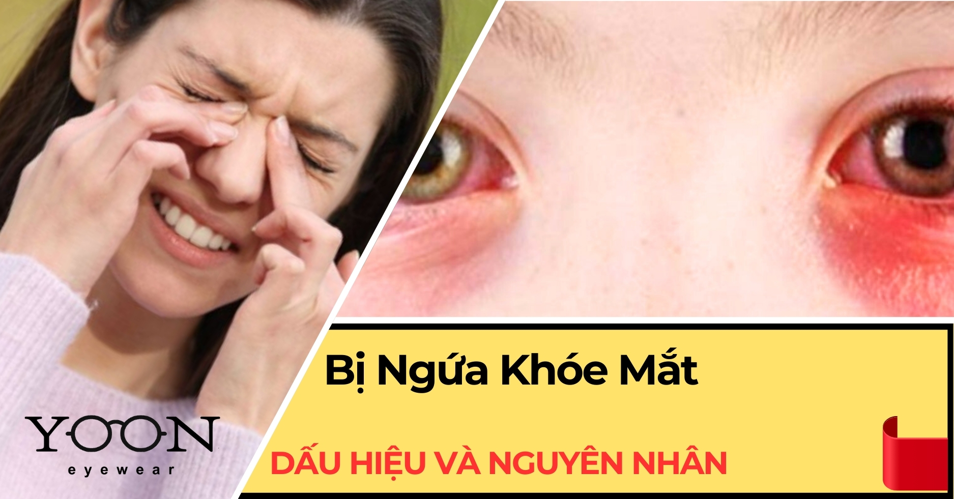 Bị Ngứa Khóe Mắt Thì Phải Làm Sao? 5 Mẹo Giúp Giảm Ngứa Khóe Mắt – Mắt ...