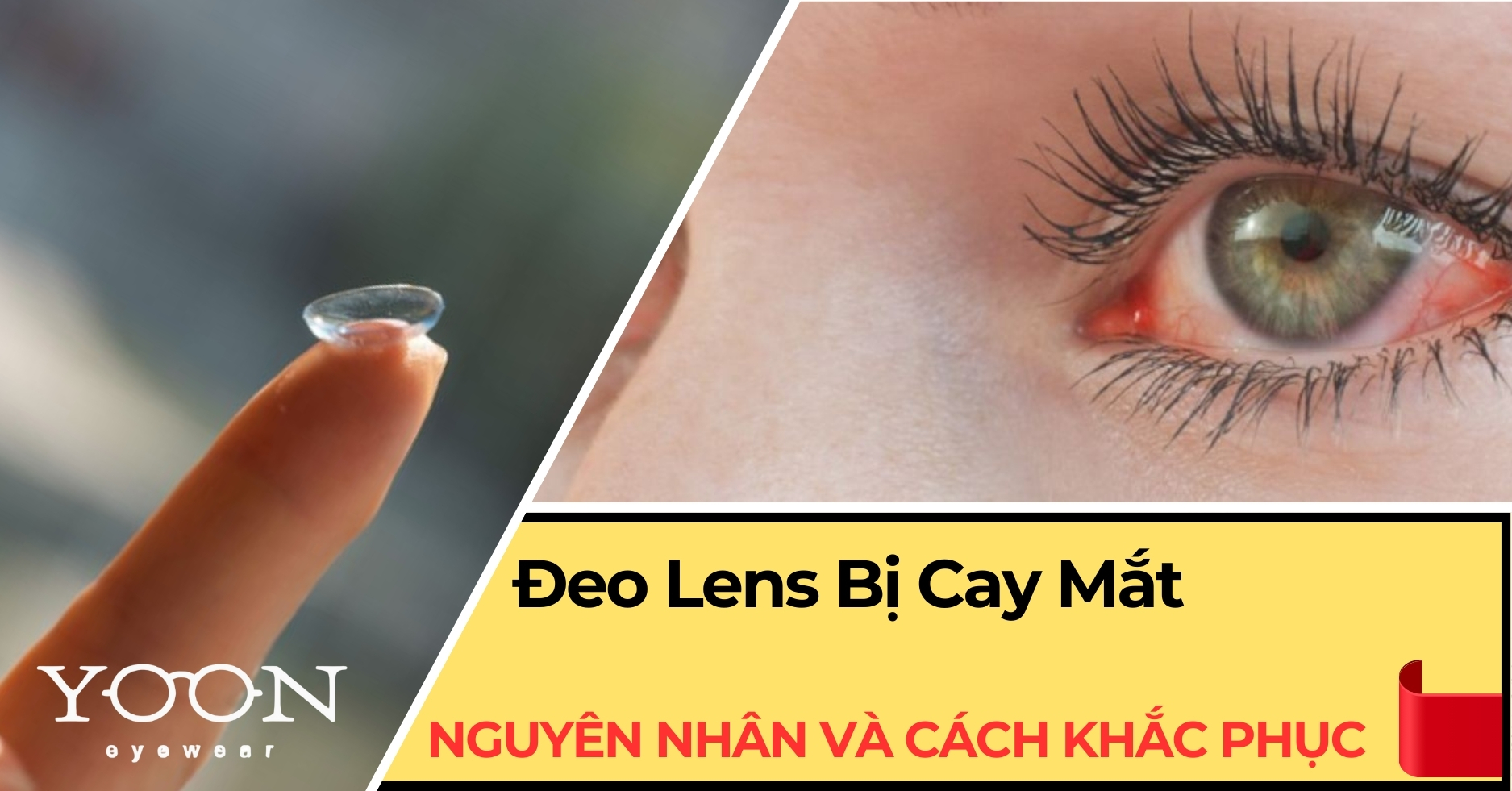 Đeo Lens Bị Cay Mắt Thì Phải Làm Sao? Nguyên Nhân Và Cách Khắc Phục ...