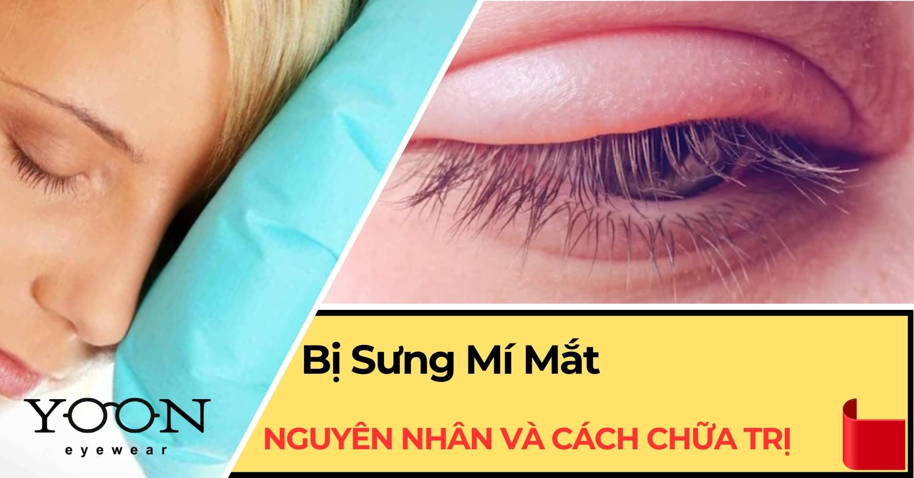 Sưng Mí Mắt - Nguyên Nhân Và Cách Phòng Tránh – Mắt Kính Yoon