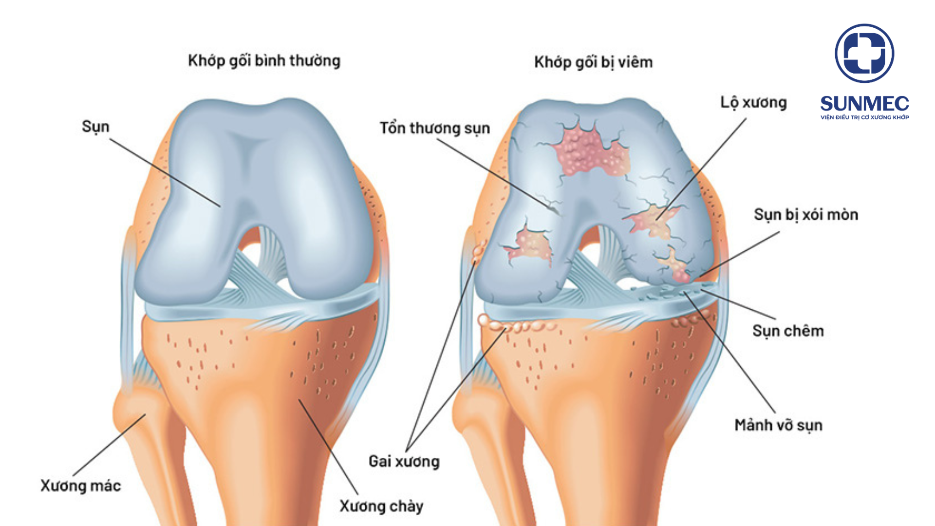 Tràn Dịch Khớp Gối – Điều Trị Không Xâm Lấn Hiệu Quả Tại Sunmec – SUNMEC