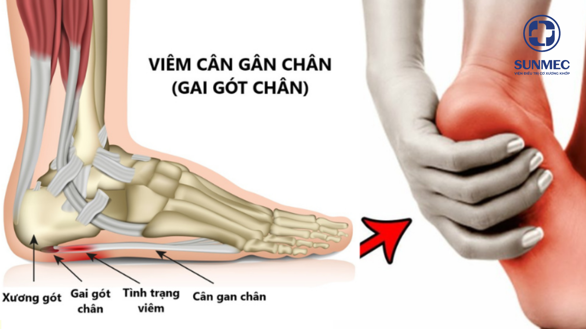 Gai Gót Chân – Nguyên Nhân, Triệu Chứng và Phương Pháp Điều Trị Không ...